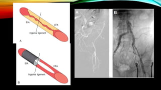 Aorto iliac interventions | PPTX