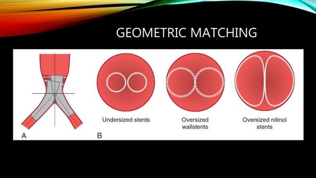 Aorto iliac interventions | PPTX | Heart and Cardiovascular Diseases ...