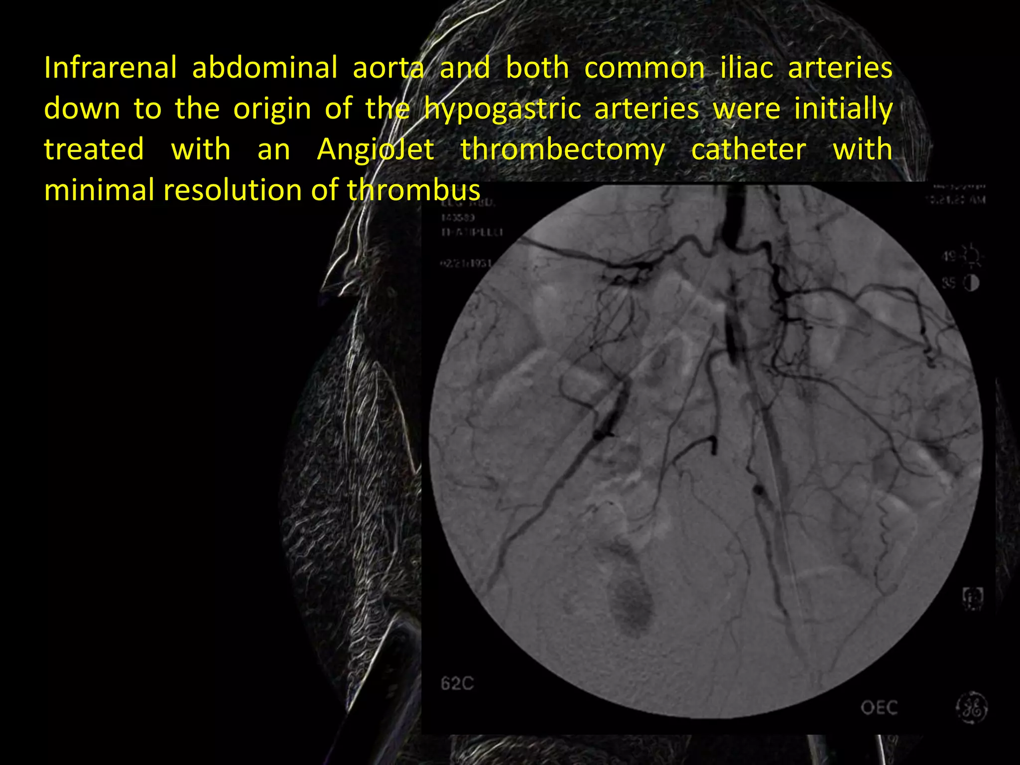 Aortoiliac occlusion rx | PDF