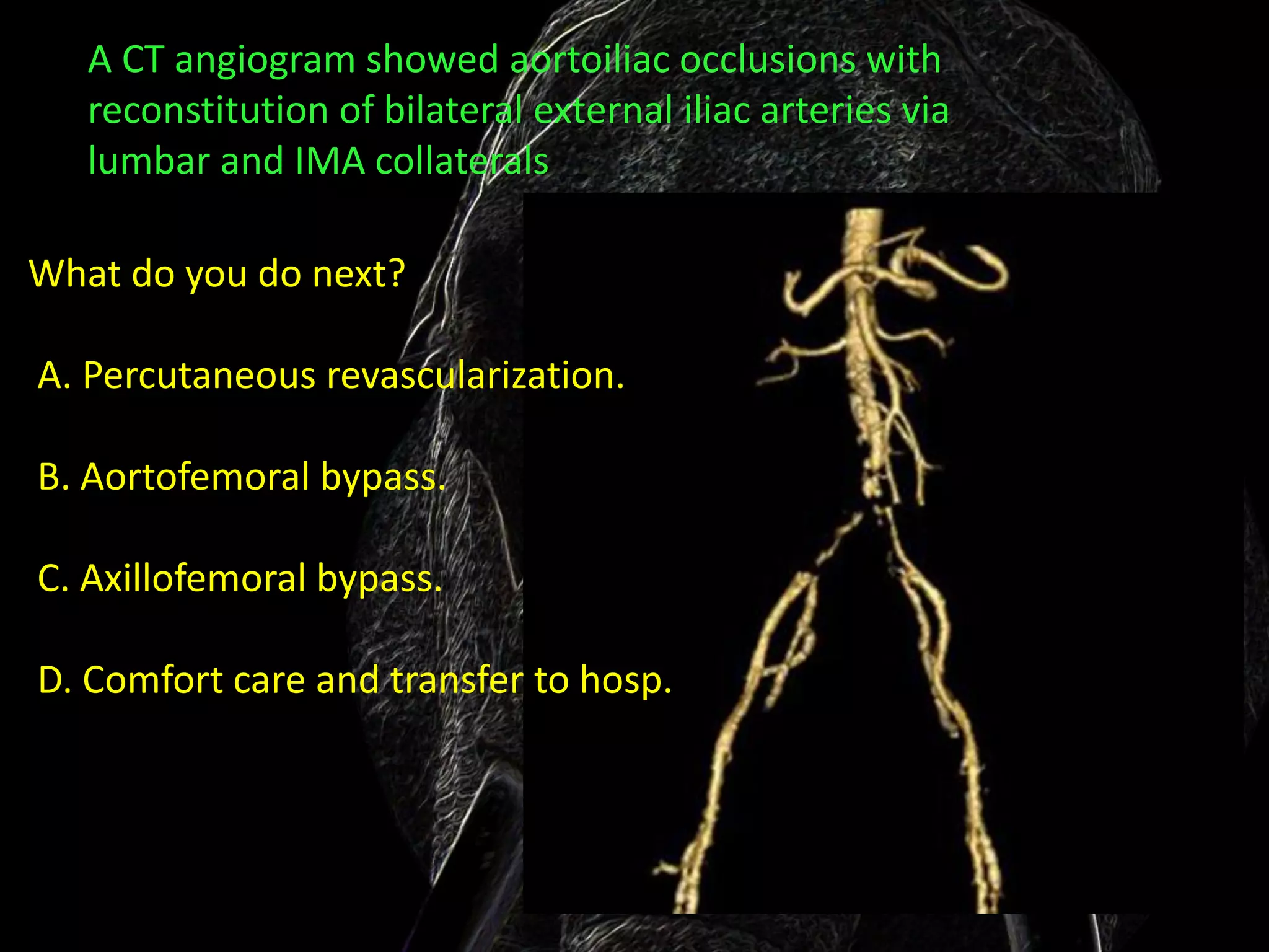 Aortoiliac occlusion rx | PDF