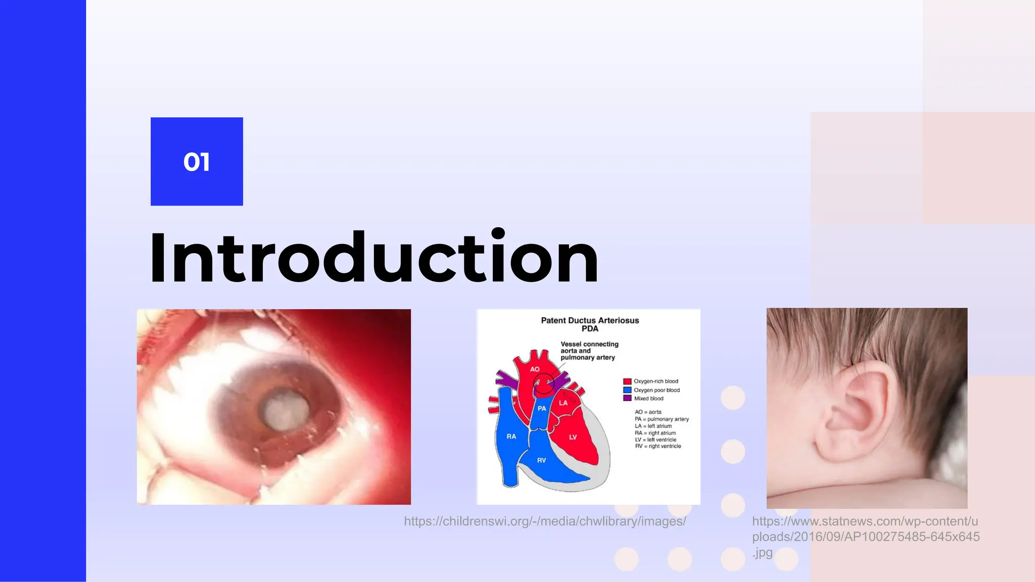 Pre- and Perioperative Measures in Rubella Cataract Management: The ...