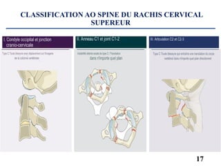 AO SPINE CLASSIFICATION IN SPÎE TRAUMA.pptx