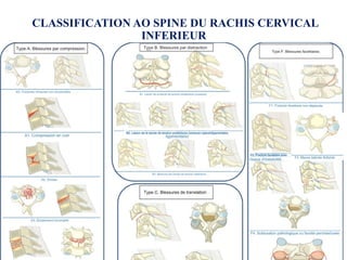 AO SPINE CLASSIFICATION IN SPÎE TRAUMA.pptx