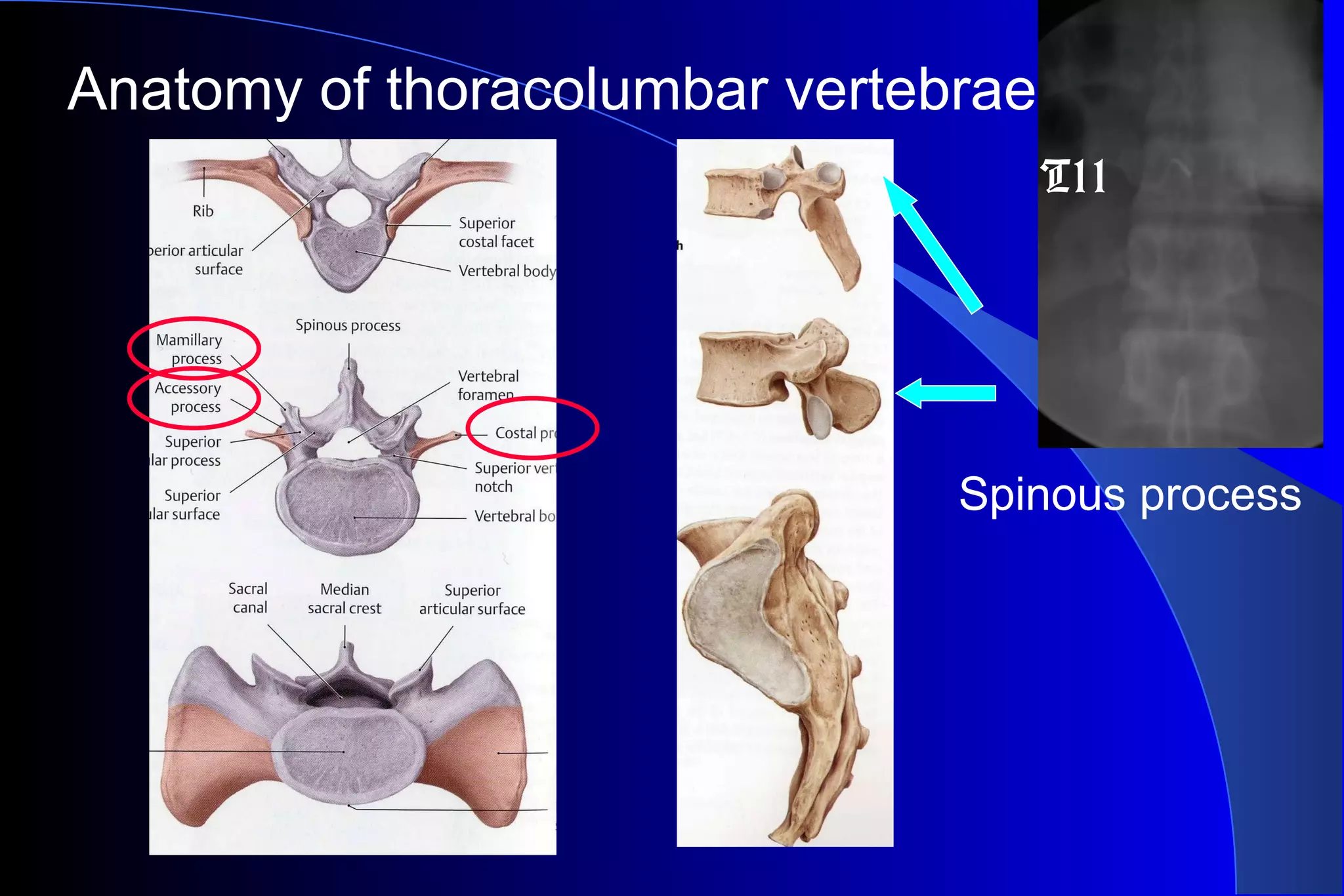 AOSPINE2010TLIF | PPT