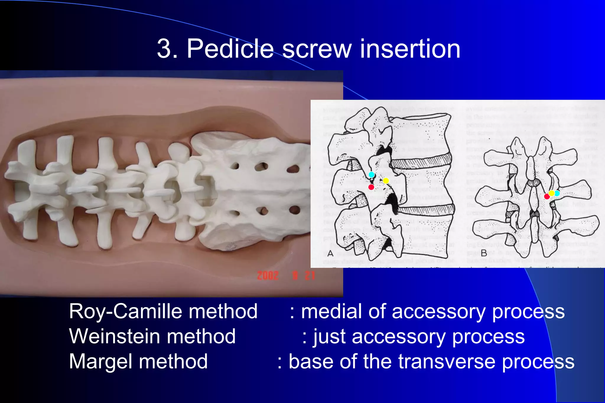 AOSPINE2010TLIF | PPT