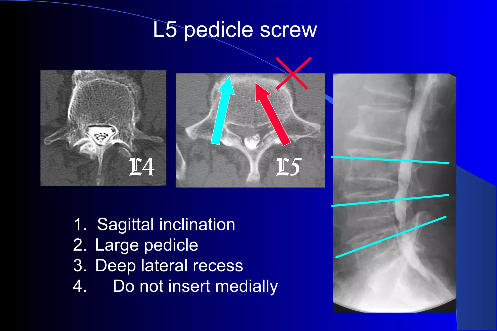 AOSPINE2010TLIF | PPT