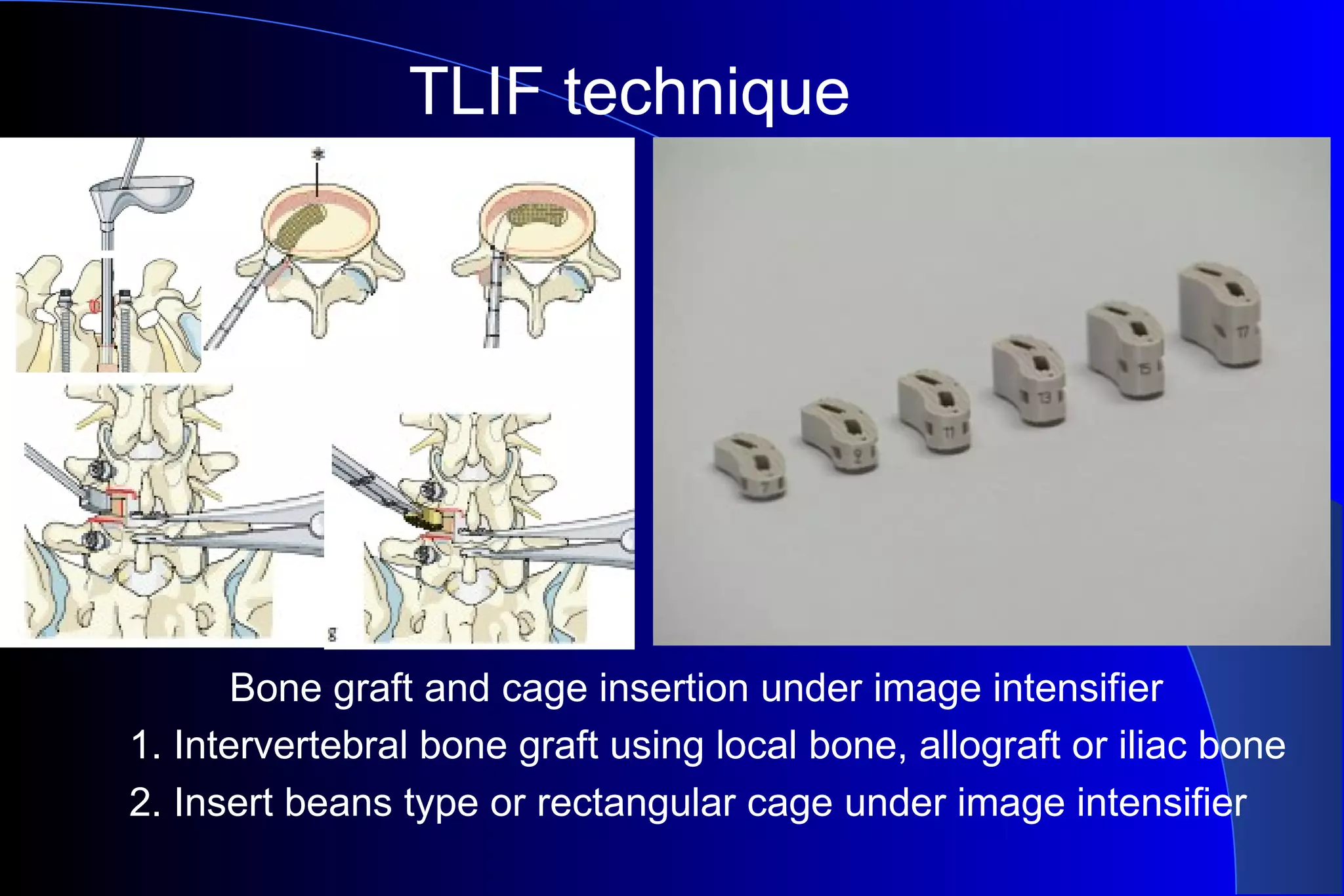 AOSPINE2010TLIF | PPT