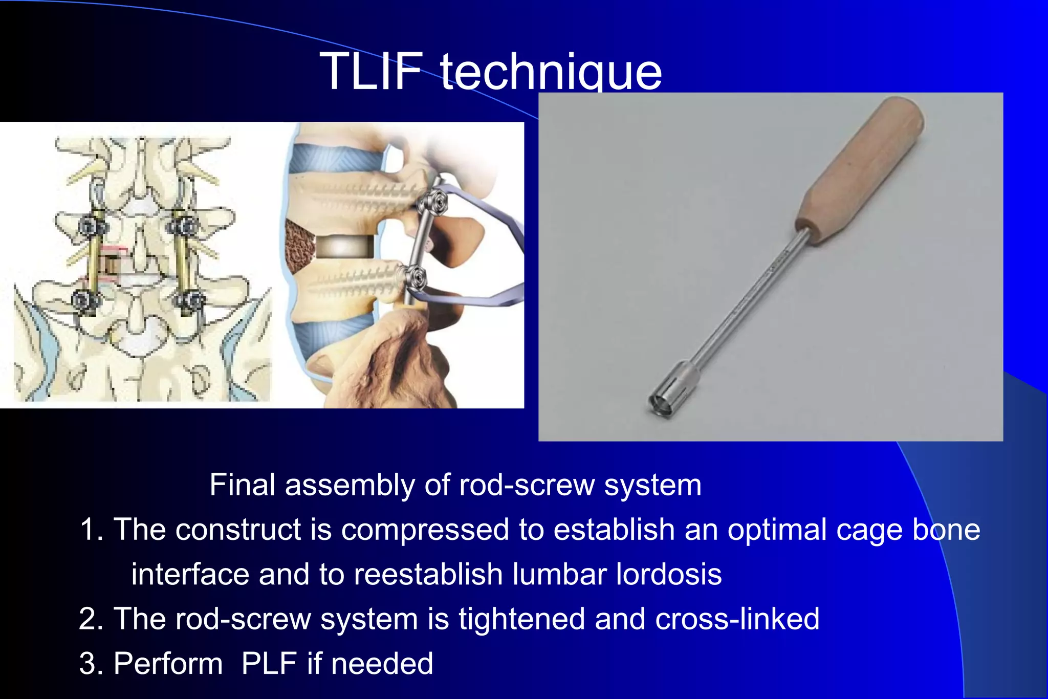 AOSPINE2010TLIF | PPT