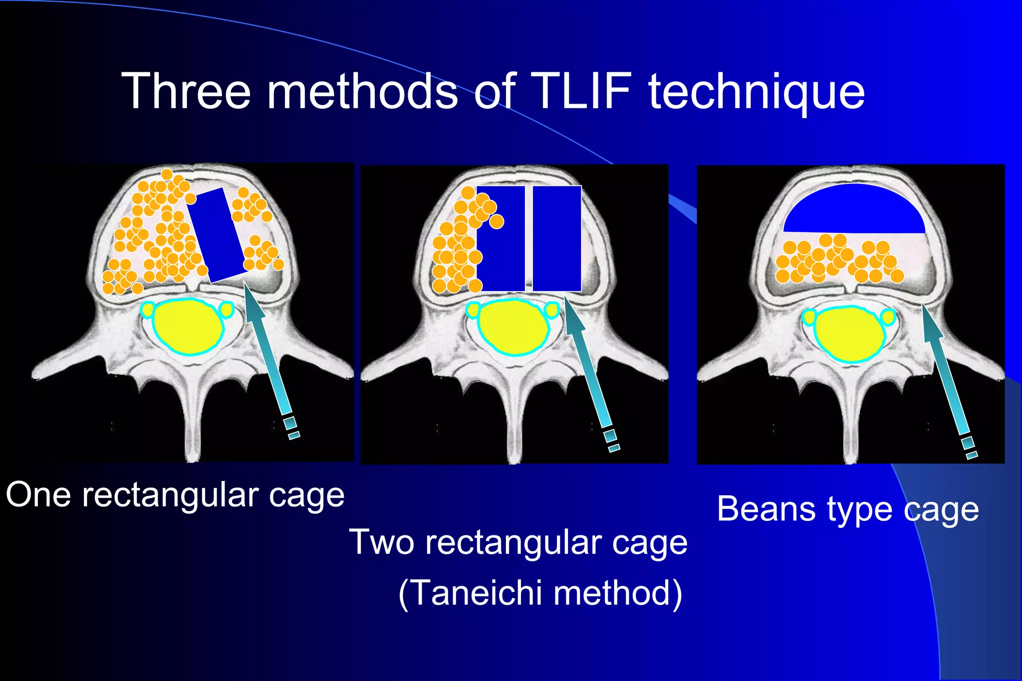 AOSPINE2010TLIF | PPT