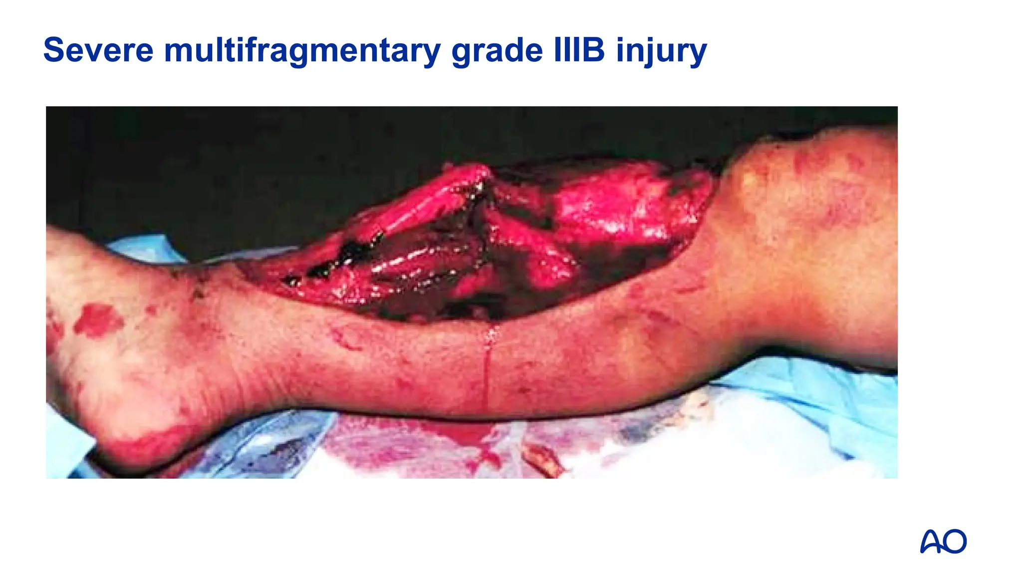 AOT_Adv_Tibial_shaft_fx_FINAL2019 (1).ppt