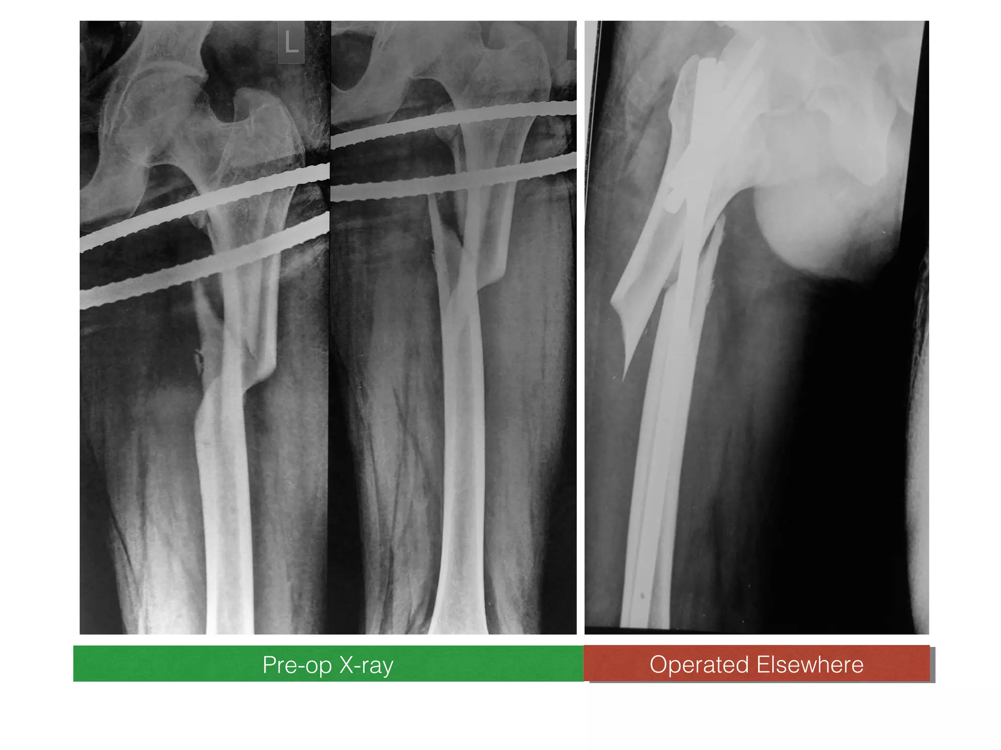 Evaluation of Outcome of Treatment of Complex Proximal Femoral ...