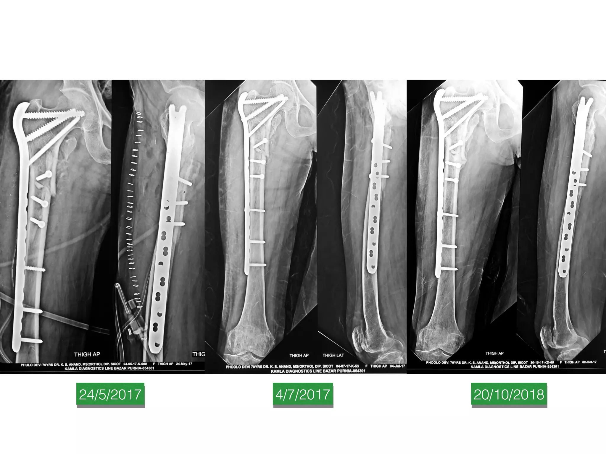 Evaluation of Outcome of Treatment of Complex Proximal Femoral ...