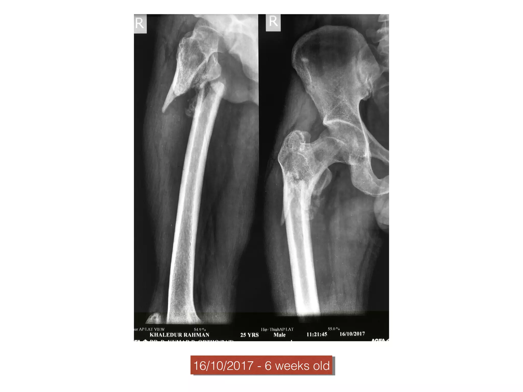 Evaluation of Outcome of Treatment of Complex Proximal Femoral ...