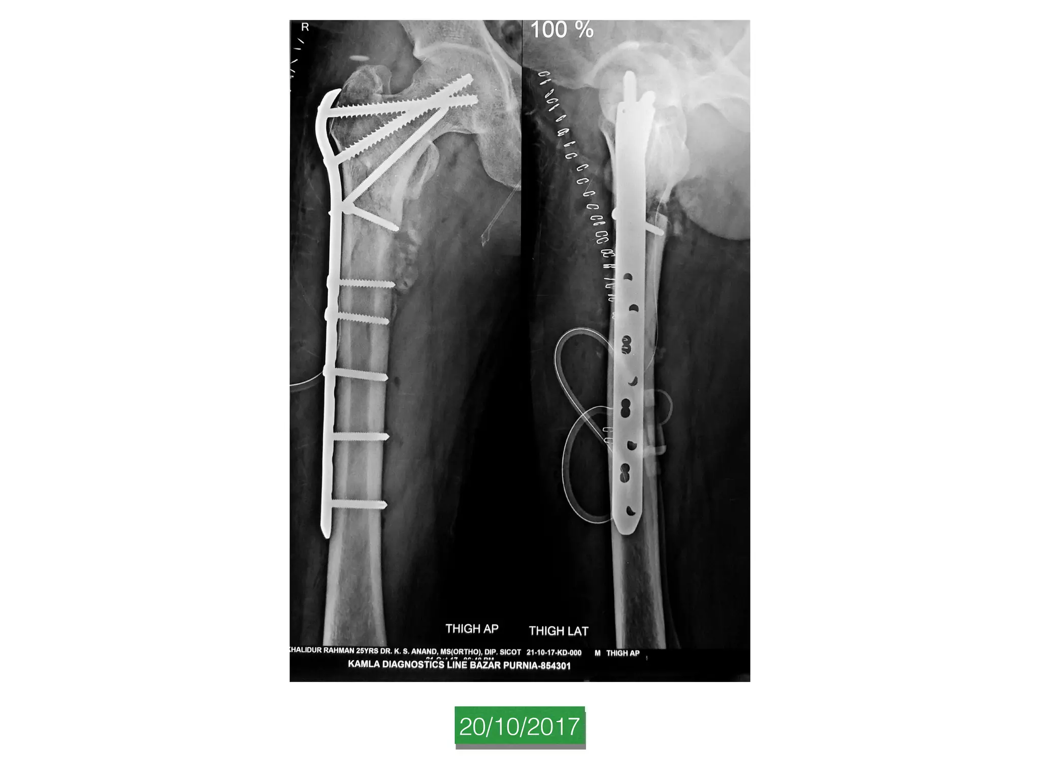 Evaluation of Outcome of Treatment of Complex Proximal Femoral ...