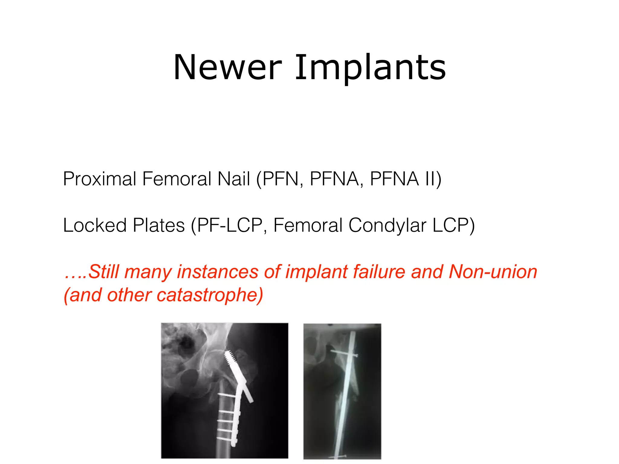 Evaluation of Outcome of Treatment of Complex Proximal Femoral ...
