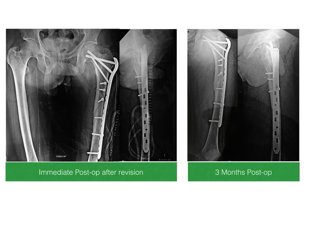 Evaluation of Outcome of Treatment of Complex Proximal Femoral ...