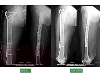 Evaluation of Outcome of Treatment of Complex Proximal Femoral ...