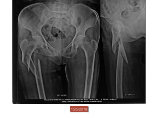 Evaluation of Outcome of Treatment of Complex Proximal Femoral ...