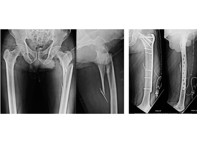 Evaluation of Outcome of Treatment of Complex Proximal Femoral ...