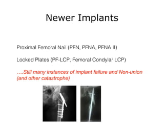 Evaluation of Outcome of Treatment of Complex Proximal Femoral ...