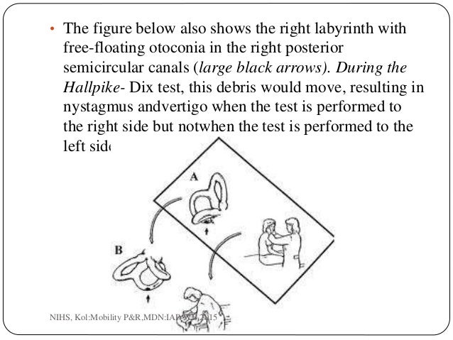 Bppv Canalith Repositioning Maneuver Hand Out