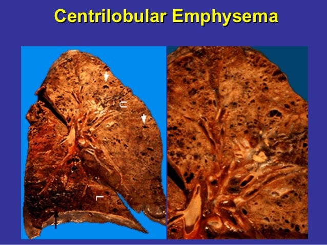 Ap 50 10-29 1 pathology of lung 1