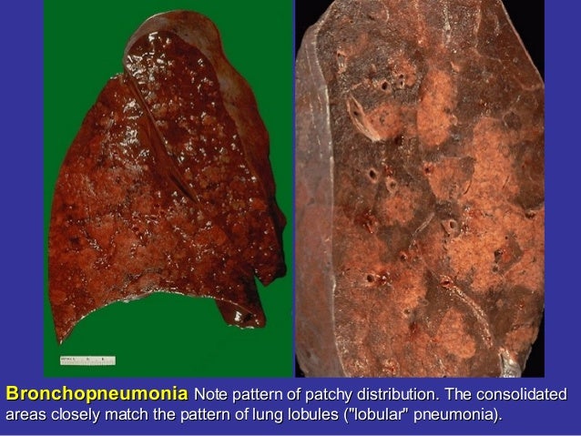 Ap 50 10-29 1 pathology of lung 1