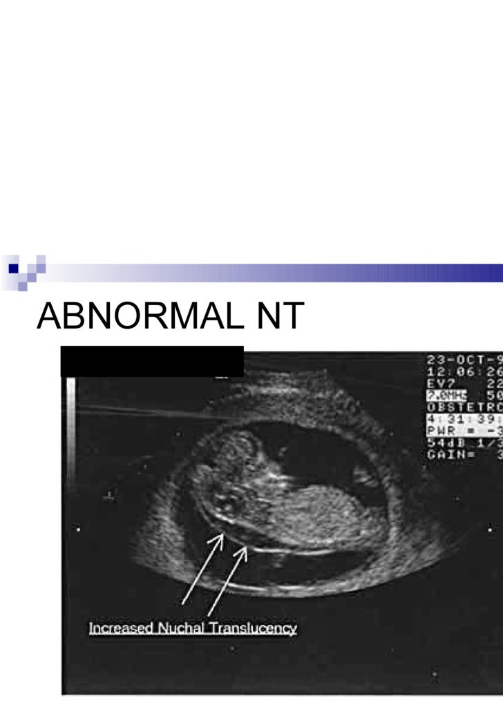Nuchal Translucency Screening