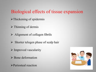 Tissue Expanders in OMFS | PPTX