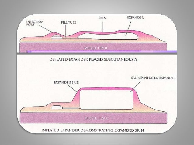 Tissue Expanders in OMFS