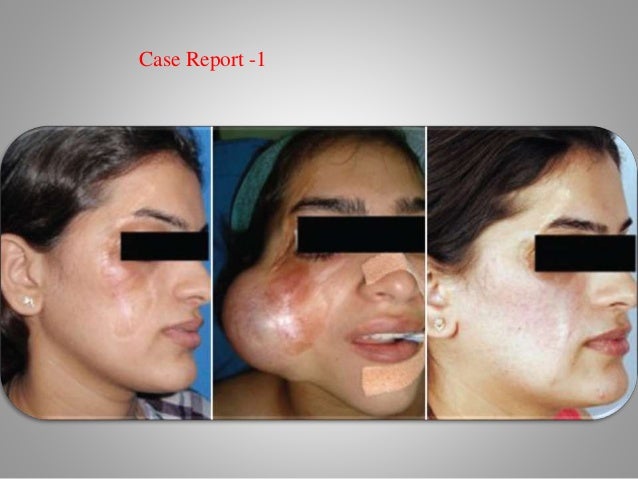 Tissue Expanders in OMFS