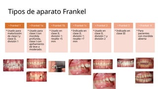 Aparatología Funcional tipo Frankel.pptx
