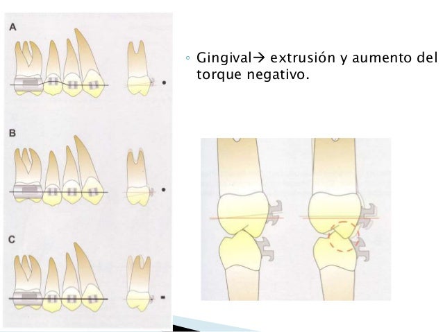 Aparatología preajustada