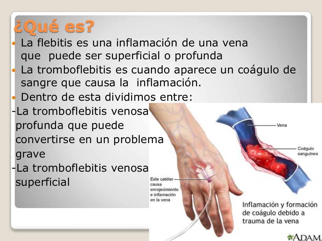 Aparición y tratamiento de una flebitis