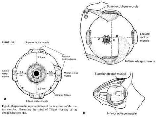 A-V pattern strabismus | PPTX | Eye and Vision Conditions | Diseases ...