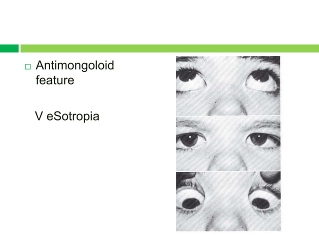 A-V pattern strabismus | PPTX | Eye and Vision Conditions | Diseases ...