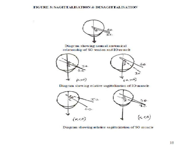 A-V pattern strabismus | PPTX | Eye and Vision Conditions | Diseases ...