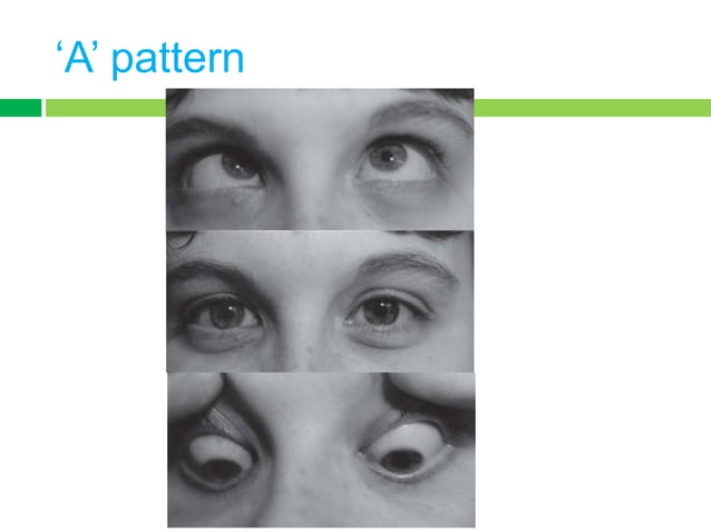 A-V pattern strabismus | PPTX | Eye and Vision Conditions | Diseases ...