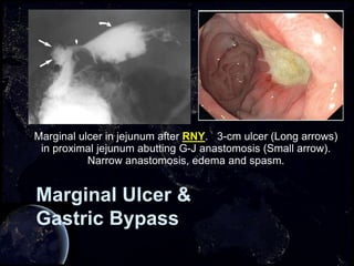 Apc a-00025-bile reflux gastritis and marginal ulcer | PPT