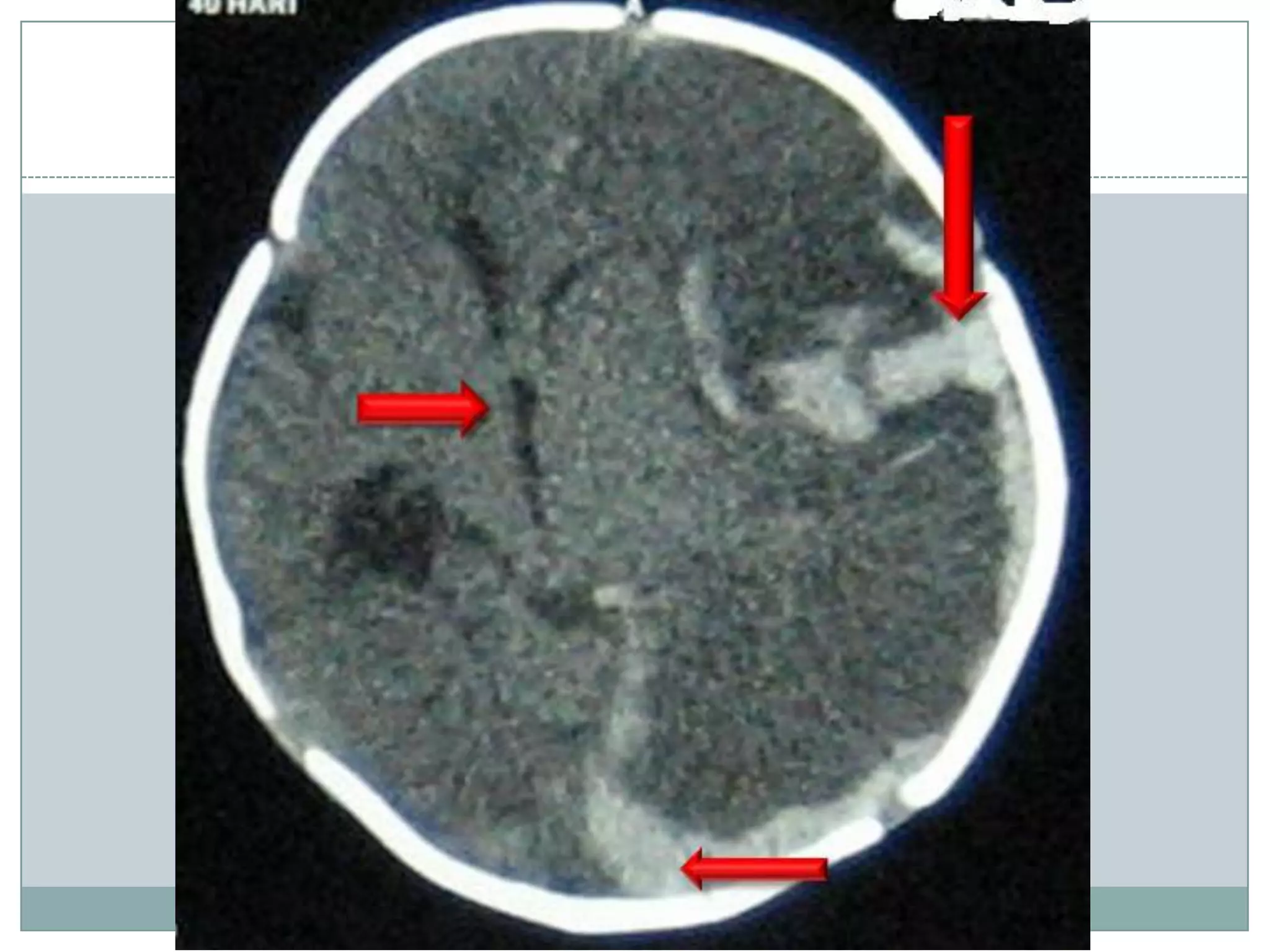 Acquired Prothrombin Complex Deficiency | PPTX