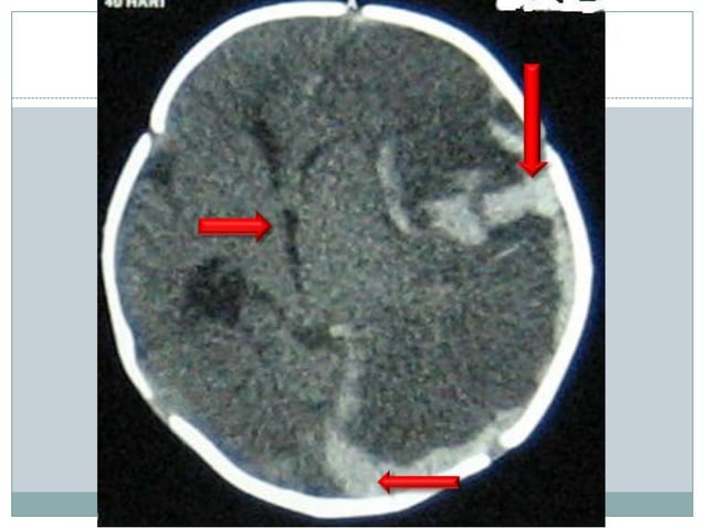 Acquired Prothrombin Complex Deficiency | PPTX