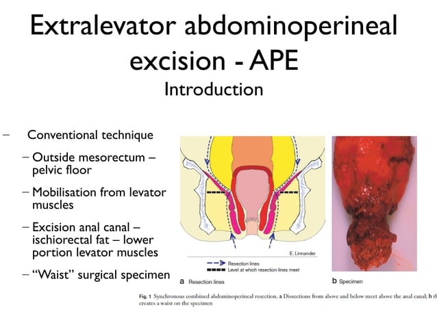 Extralevator abdominoperineal excision | PPT