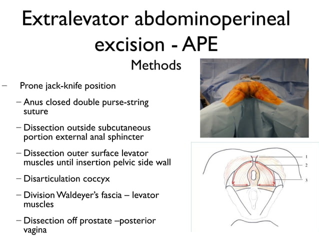 Extralevator abdominoperineal excision | PPT