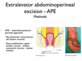 Extralevator abdominoperineal excision | PPT