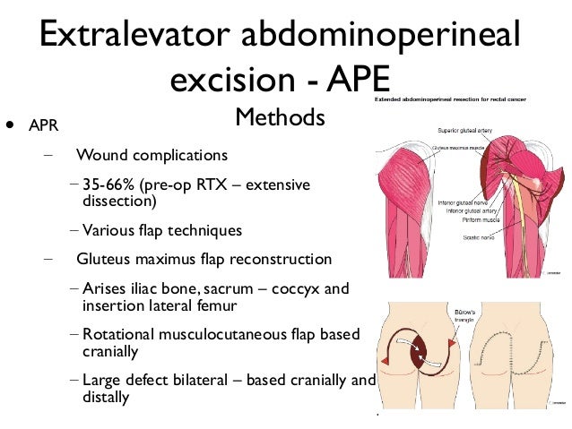 Extralevator abdominoperineal excision