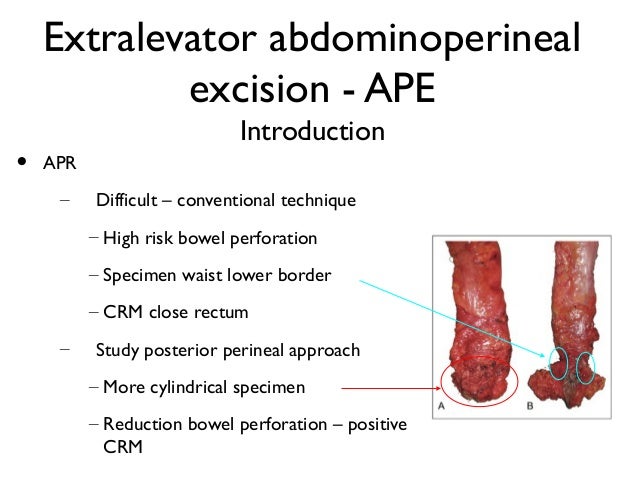 Extralevator abdominoperineal excision