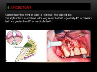 Apeceoctomy traditional and new concepts | PPTX