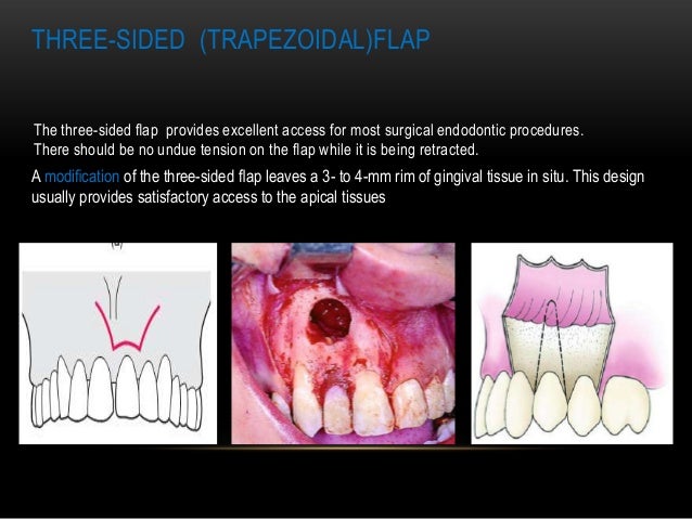 Apeceoctomy traditional and new concepts
