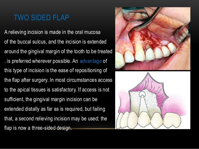 Apeceoctomy traditional and new concepts