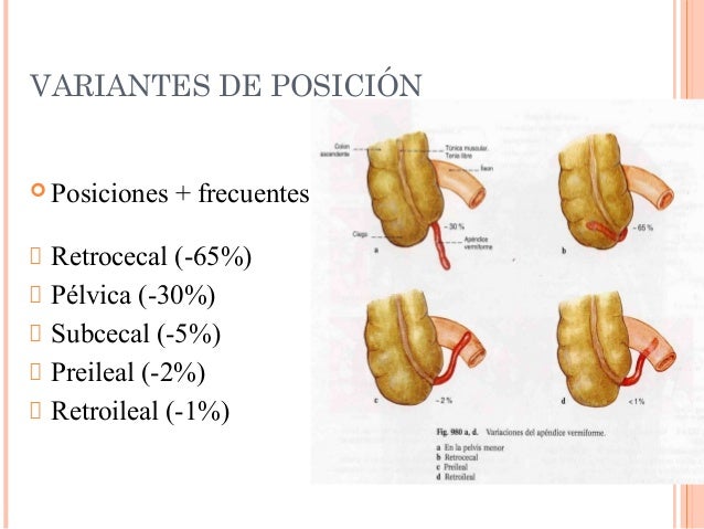 Apendicitis aguda